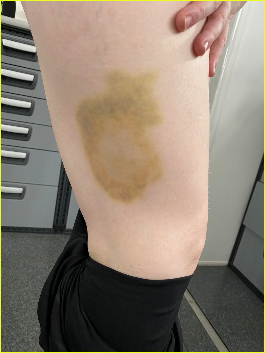 Bryce Dallas Howard Shows Off Her Massive Bruises from 'Jurassic World ...